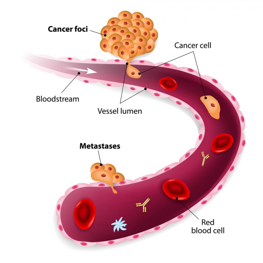 Cancer limfatic: cauze, simptome, diagnostic, tratament