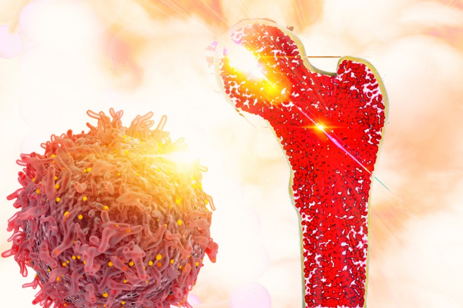 Cancer osos: ce este, tipuri, cauze, simptome, preventie, tratament